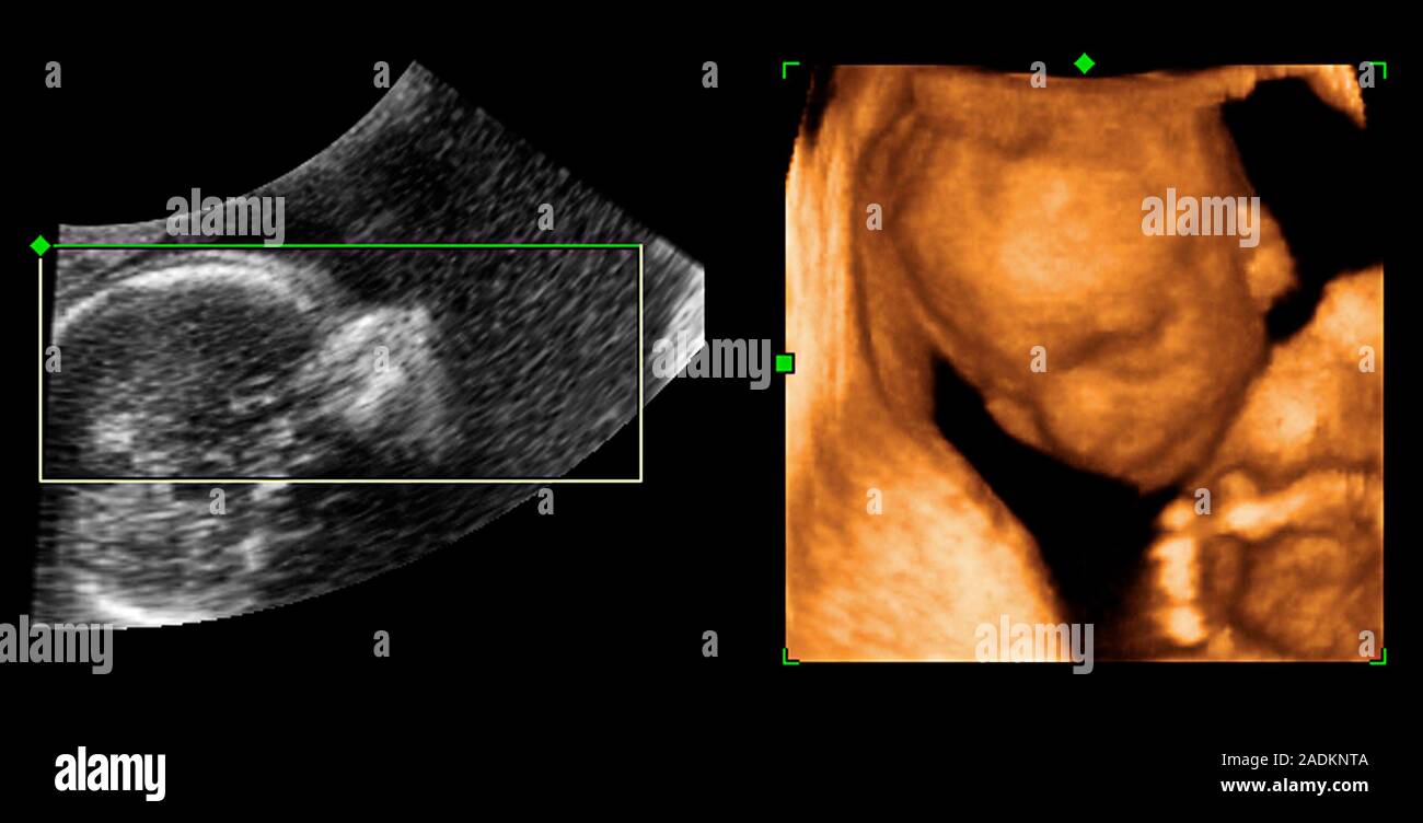 Foetus. 2-D and coloured 3-D ultrasound scans of a 17 week old foetus ...
