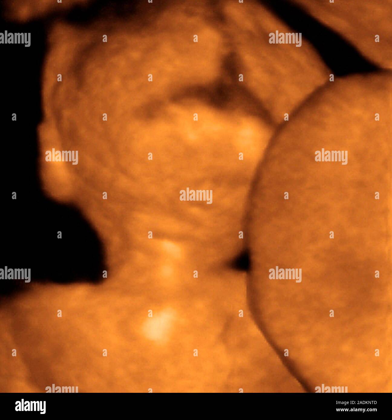 Foetus. Coloured 3-D ultrasound scan of the back of a foetus' head. The ...