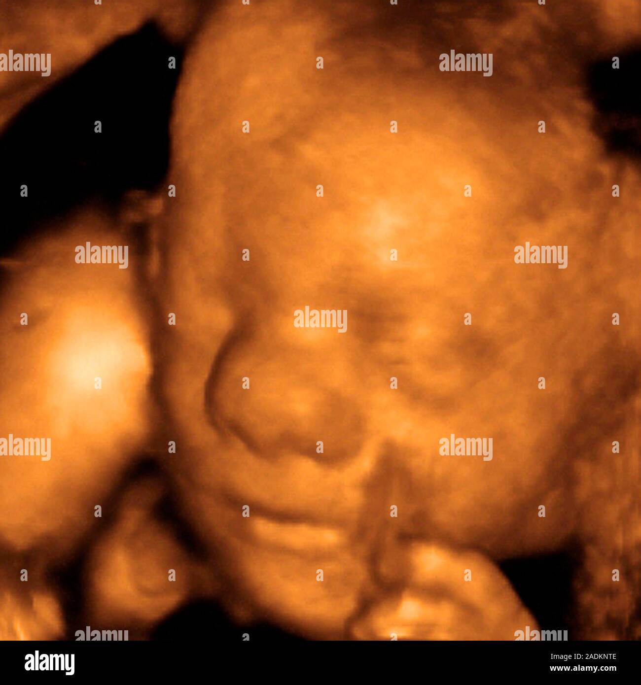 Foetus's face. Coloured 3-D ultrasound scan of a foetus' face looking ...