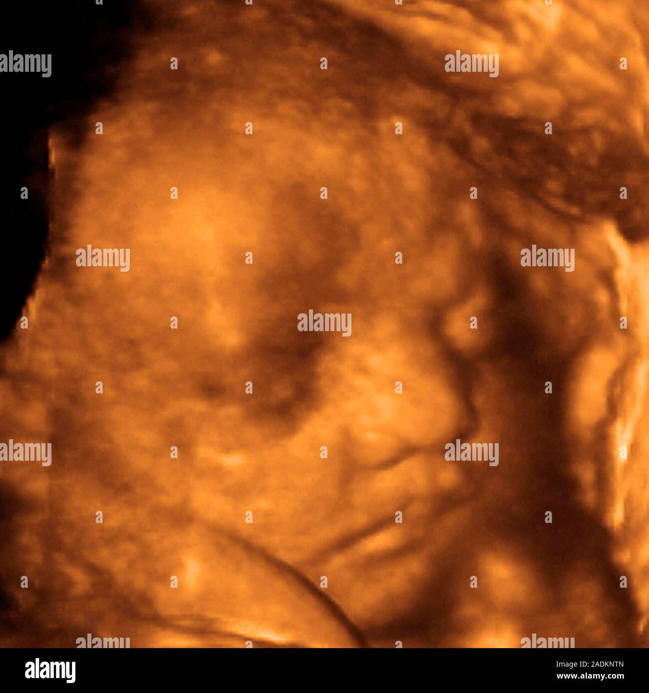 Foetus's face. Coloured 3-D ultrasound scan of a foetus' face. The ...