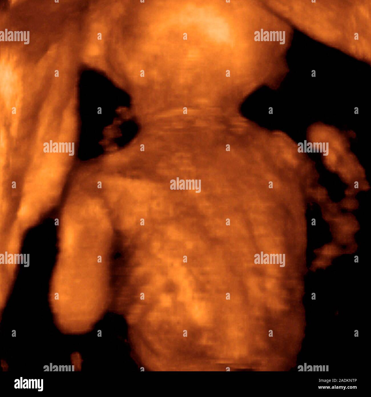 Foetus's back. Coloured 3-D ultrasound scan of a foetus' back. The ...