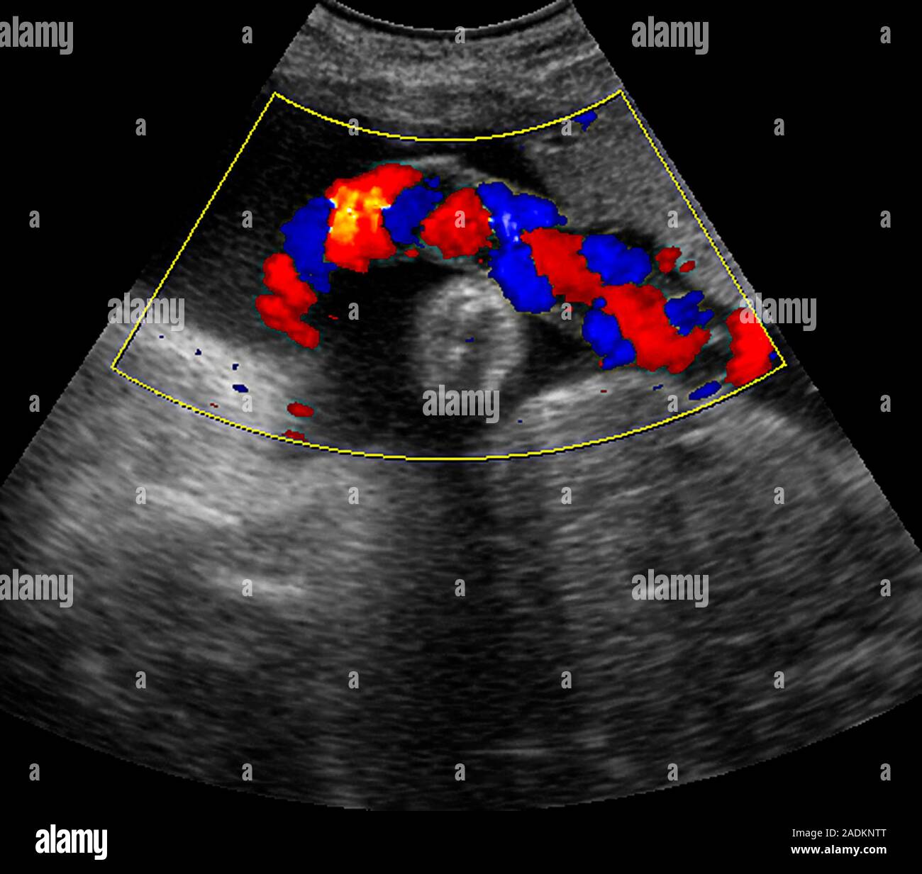Umbilical blood flow. Coloured doppler ultrasound scan showing ...