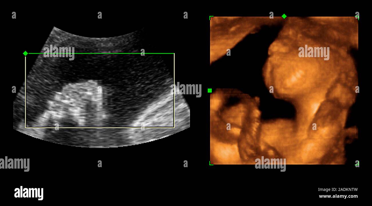 Foetus. 2-D and coloured 3-D ultrasound scans of the face of a foetus ...