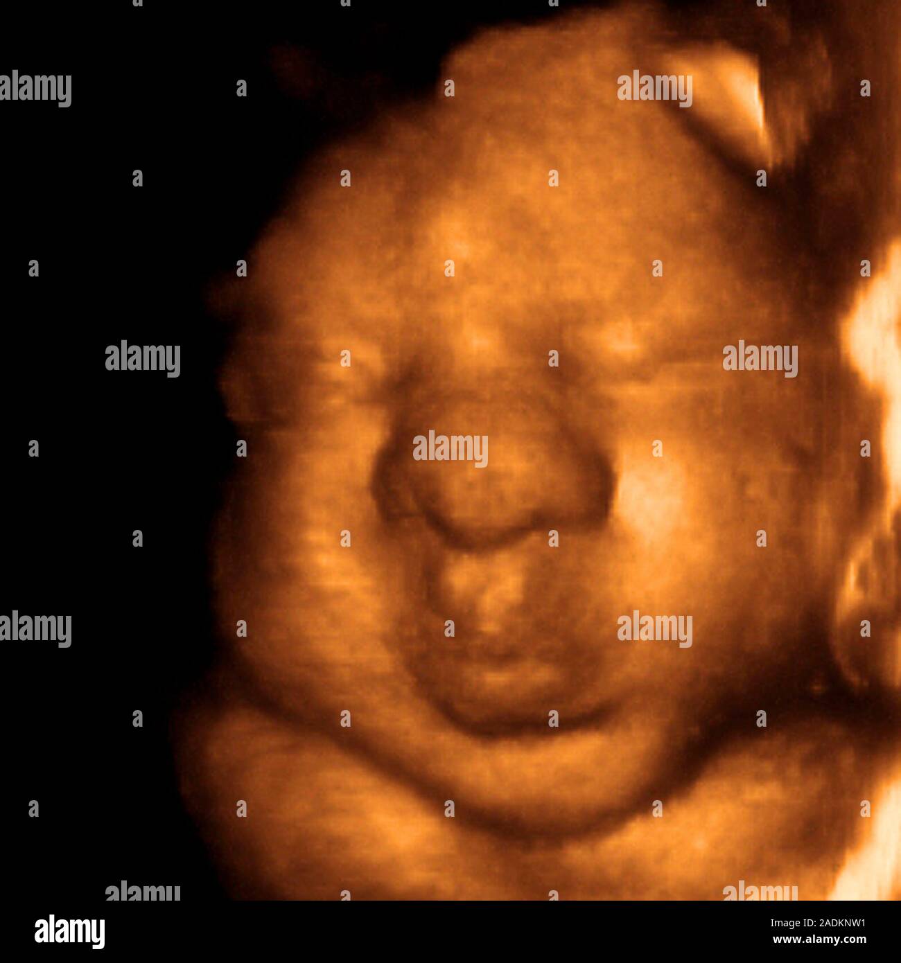 Foetus's face. Coloured 3-D ultrasound scan of a foetus' face with ...