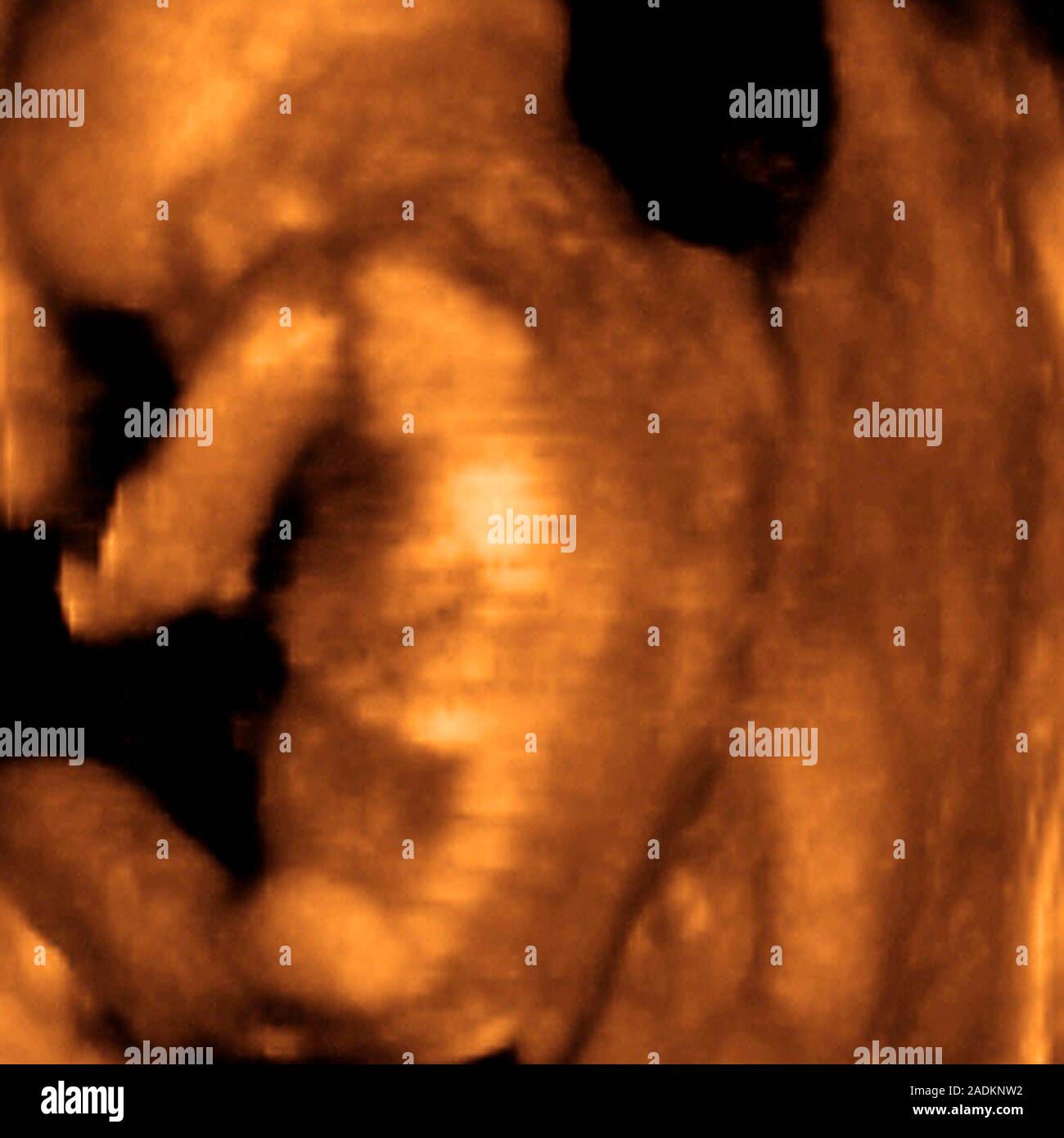 Foetus's back. Coloured 3-D ultrasound scan of a foetus' back. The ...