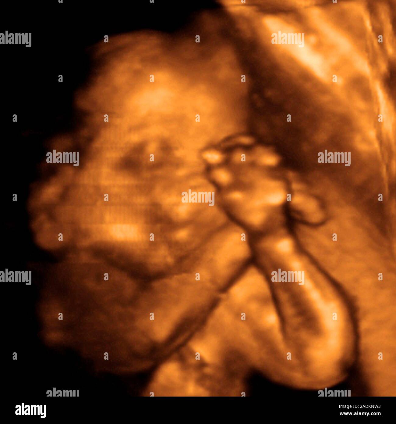 Foetus. Coloured 3-D ultrasound scan of a foetus with crossed arms ...