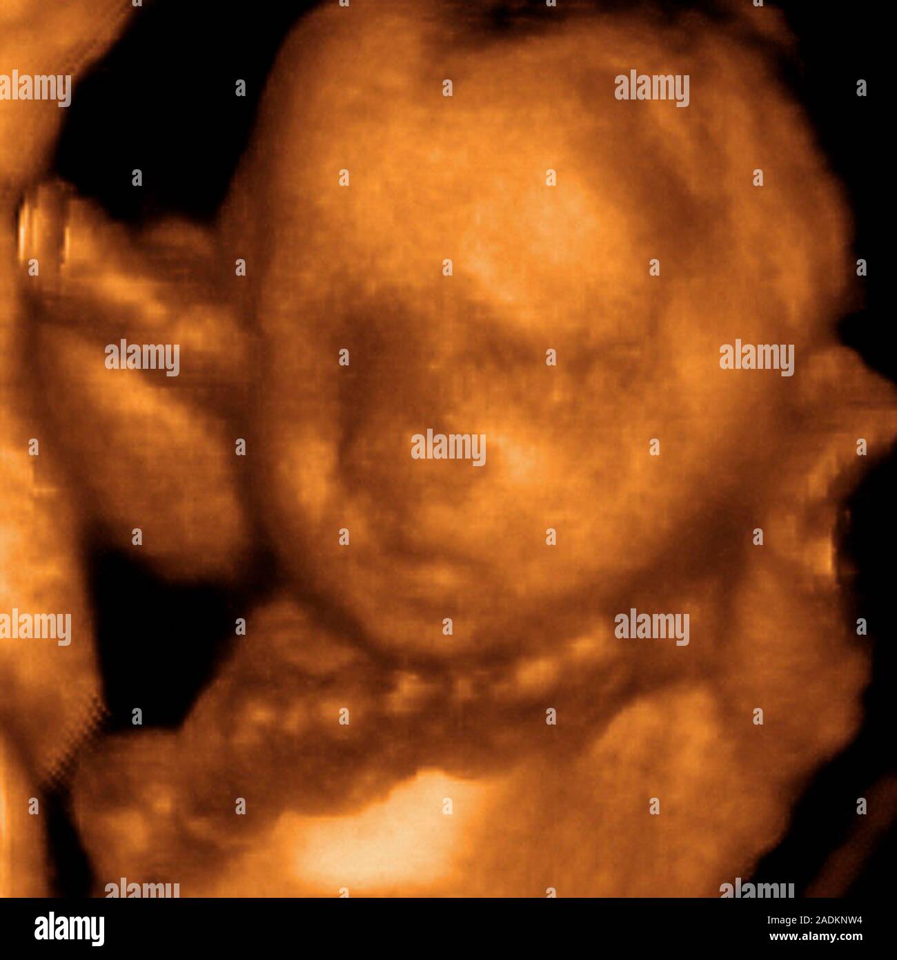 Foetus. Coloured 3-D ultrasound scan of a foetus with its umbilical ...