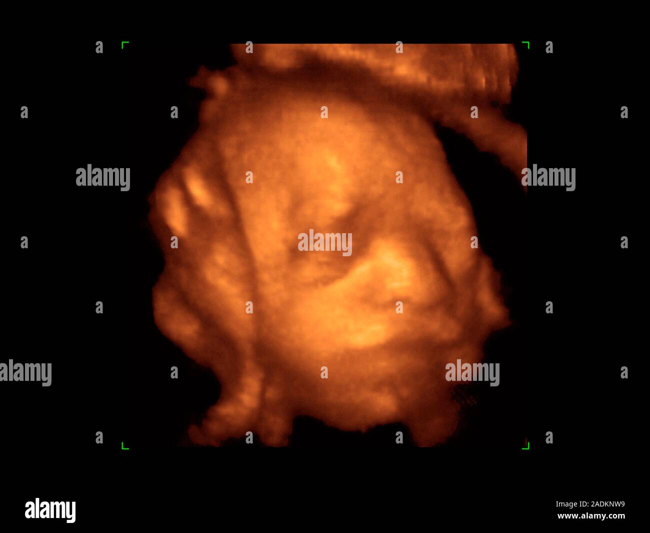 Foetus' face. Coloured 3-D ultrasound scan of a 25 week old foetus ...