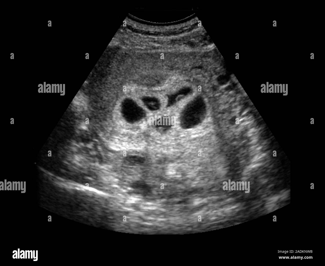 Quintuplet foetuses. Ultrasound scan of quintuplet foetuses (black ...