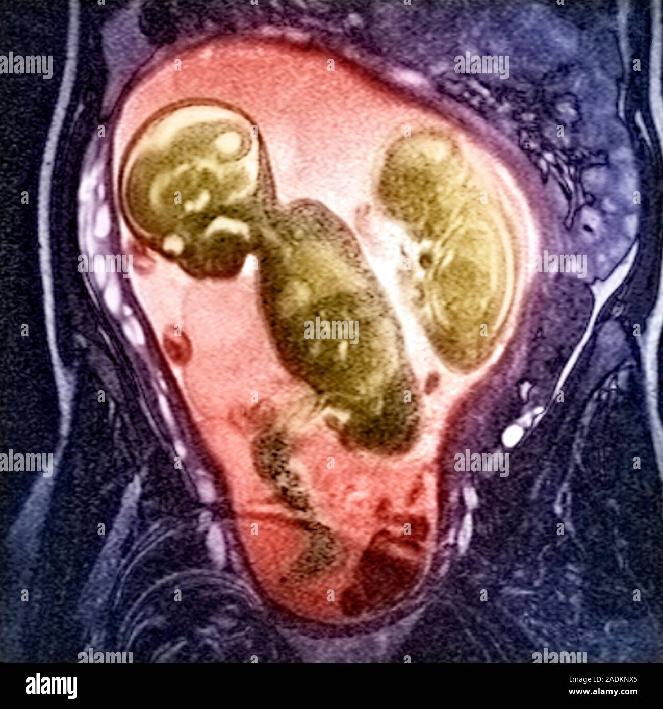 Twin foetuses. Coloured magnetic resonance imaging (MRI) scan of a ...