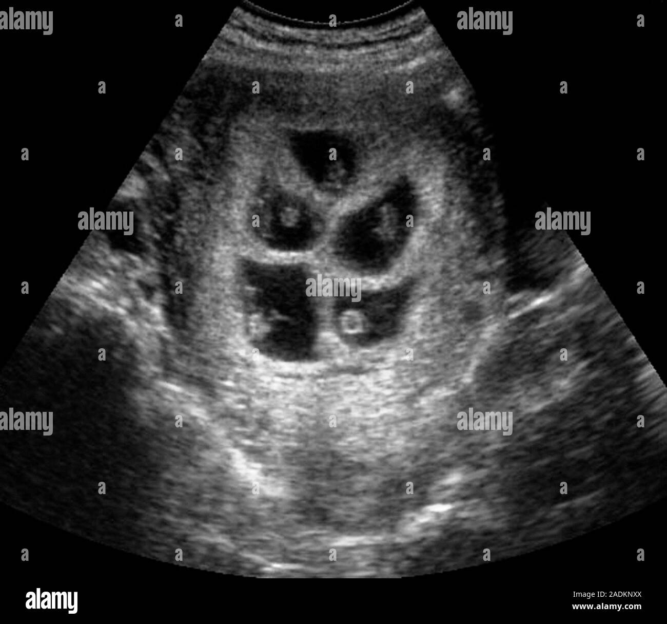 Quintuplet foetuses. Ultrasound scan of quintuplet foetuses (black ...