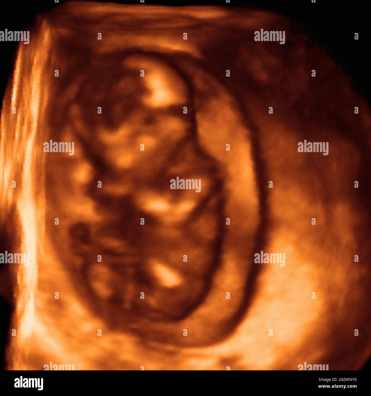 Foetus. Coloured 3-D ultrasound scan of a foetus. Its head (upper ...
