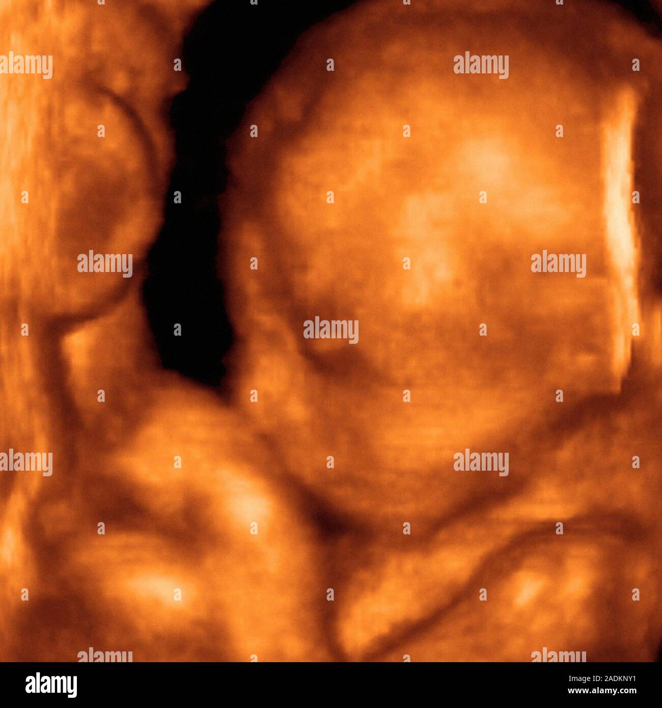 Foetus' face. Coloured 3-D ultrasound scan of a foetus' face in profile ...