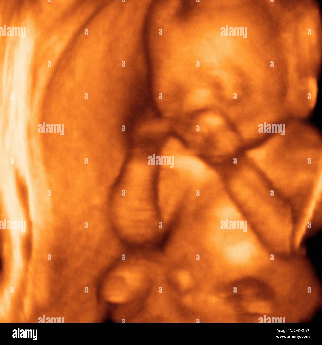 Foetus. Coloured 3-D ultrasound scan of a foetus. It is holding its ...