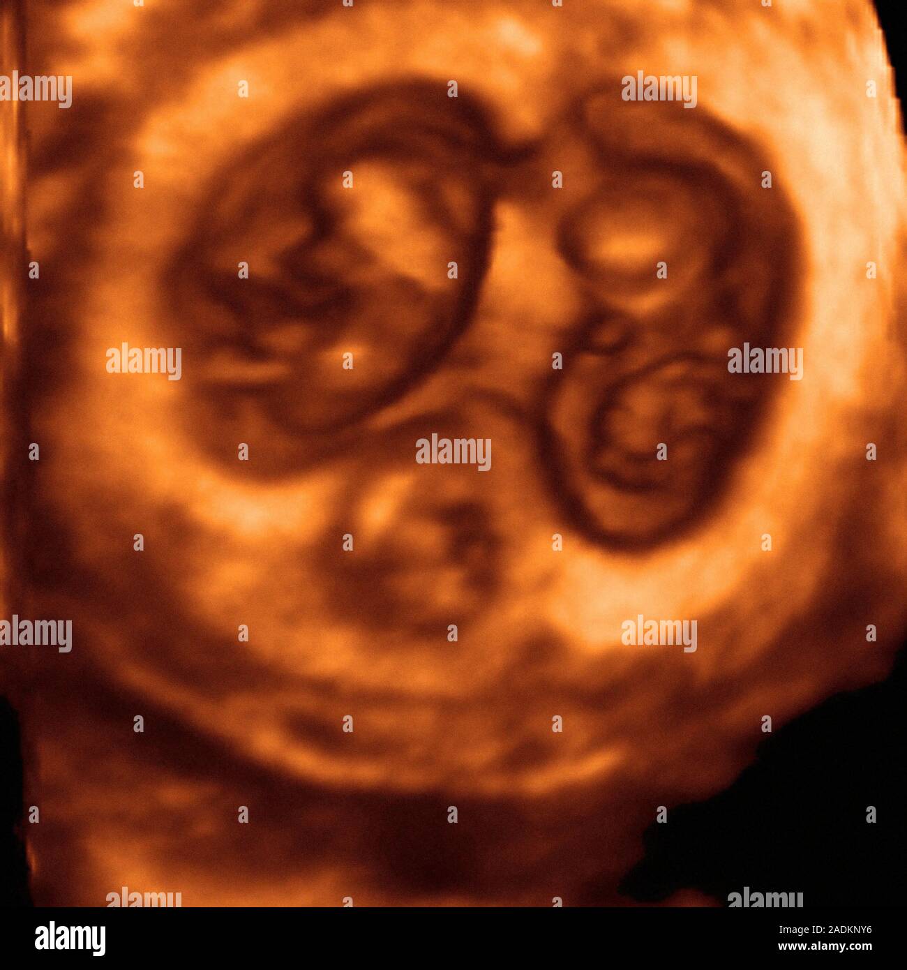 Triplet foetuses. Coloured 3-D ultrasound scan of triplets. Non-identical triplets develop when ...