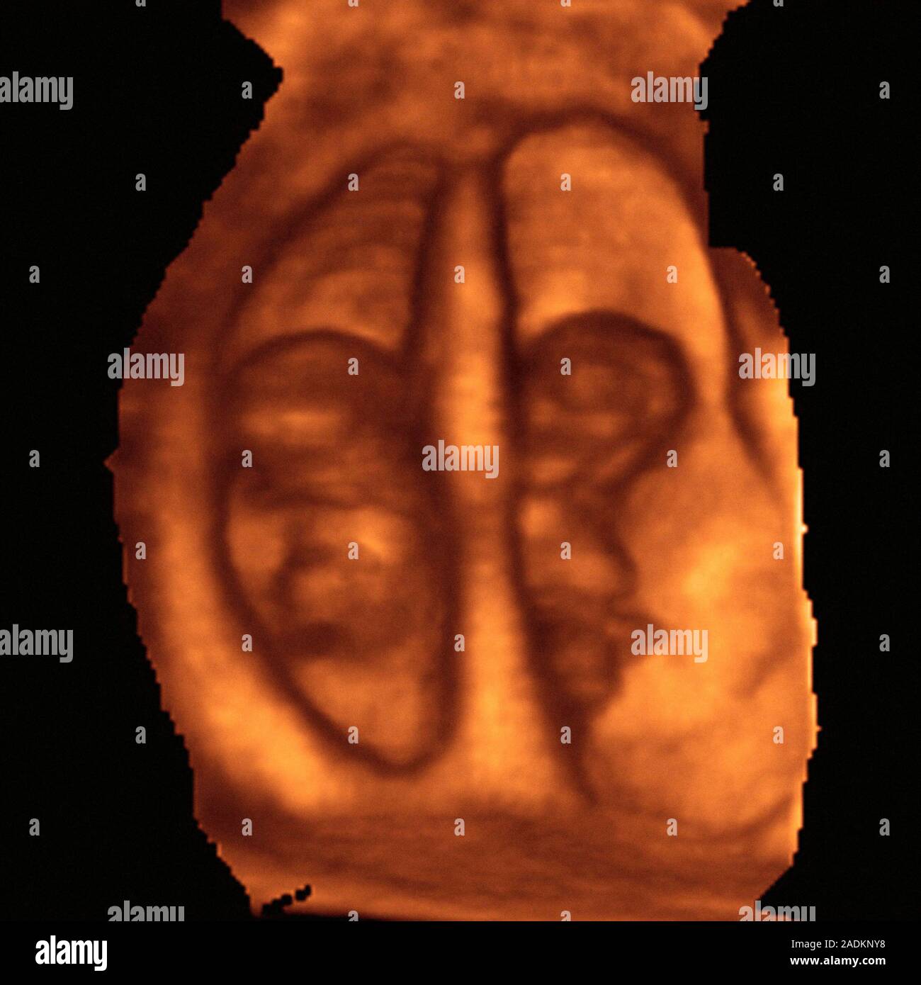 Twin foetuses. Coloured 3-D ultrasound scan of twins. These twins are ...