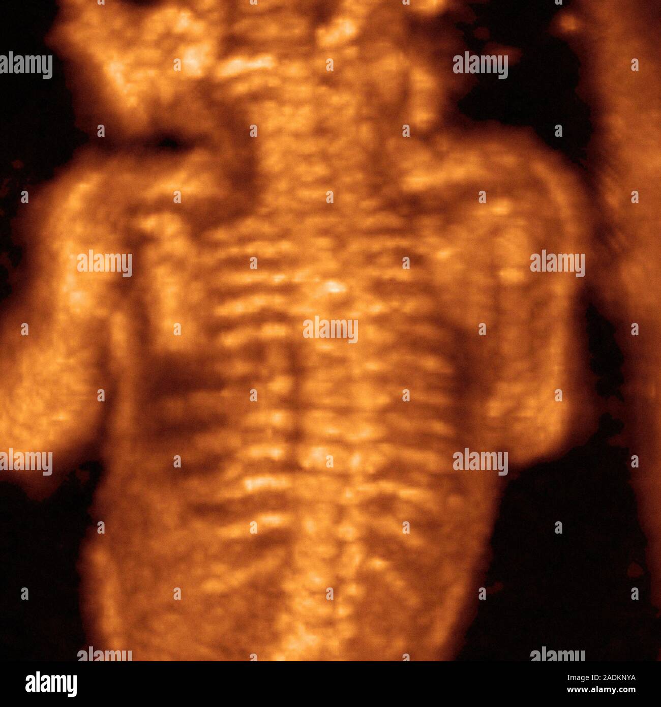 Foetus skeleton. Coloured 3-D ultrasound scan of part of the skeleton ...