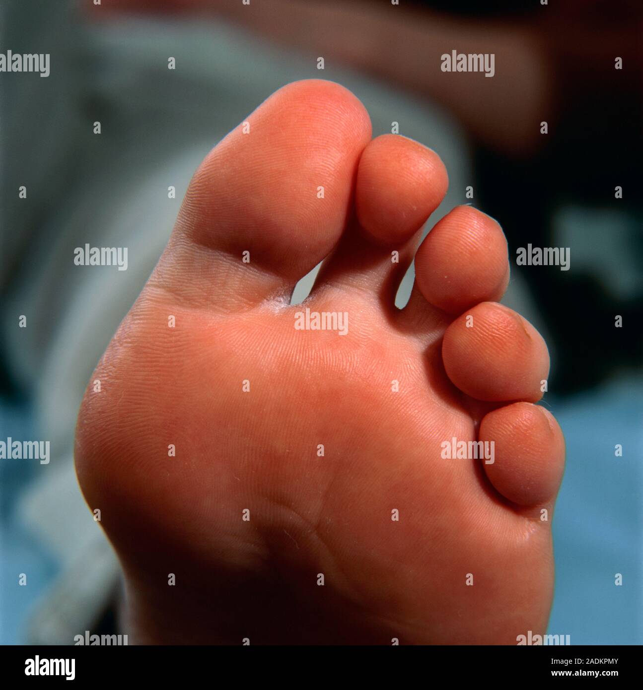 Toes. Ventral view of a woman's foot, showing healthy toes and part of ...