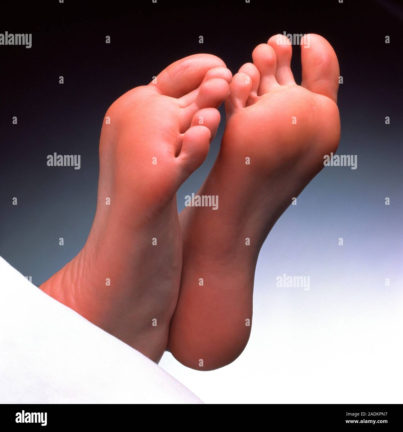 Soles of the feet. Ventral view of two crossed feet, showing healthy ...