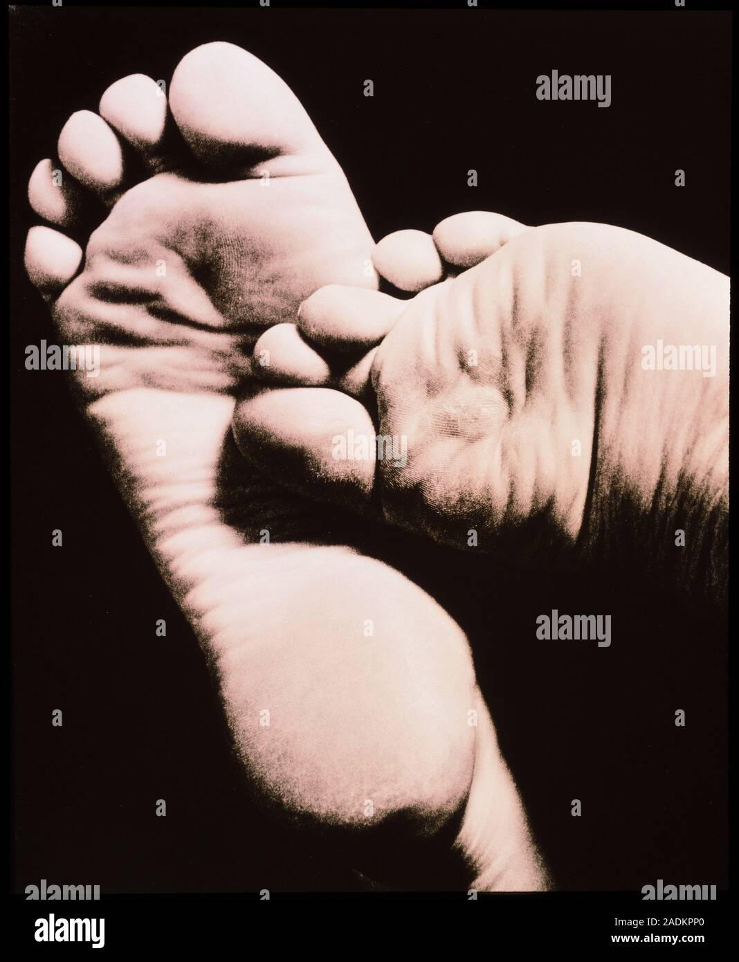 Soles of the feet. Ventral view of two feet of a woman, showing their ...