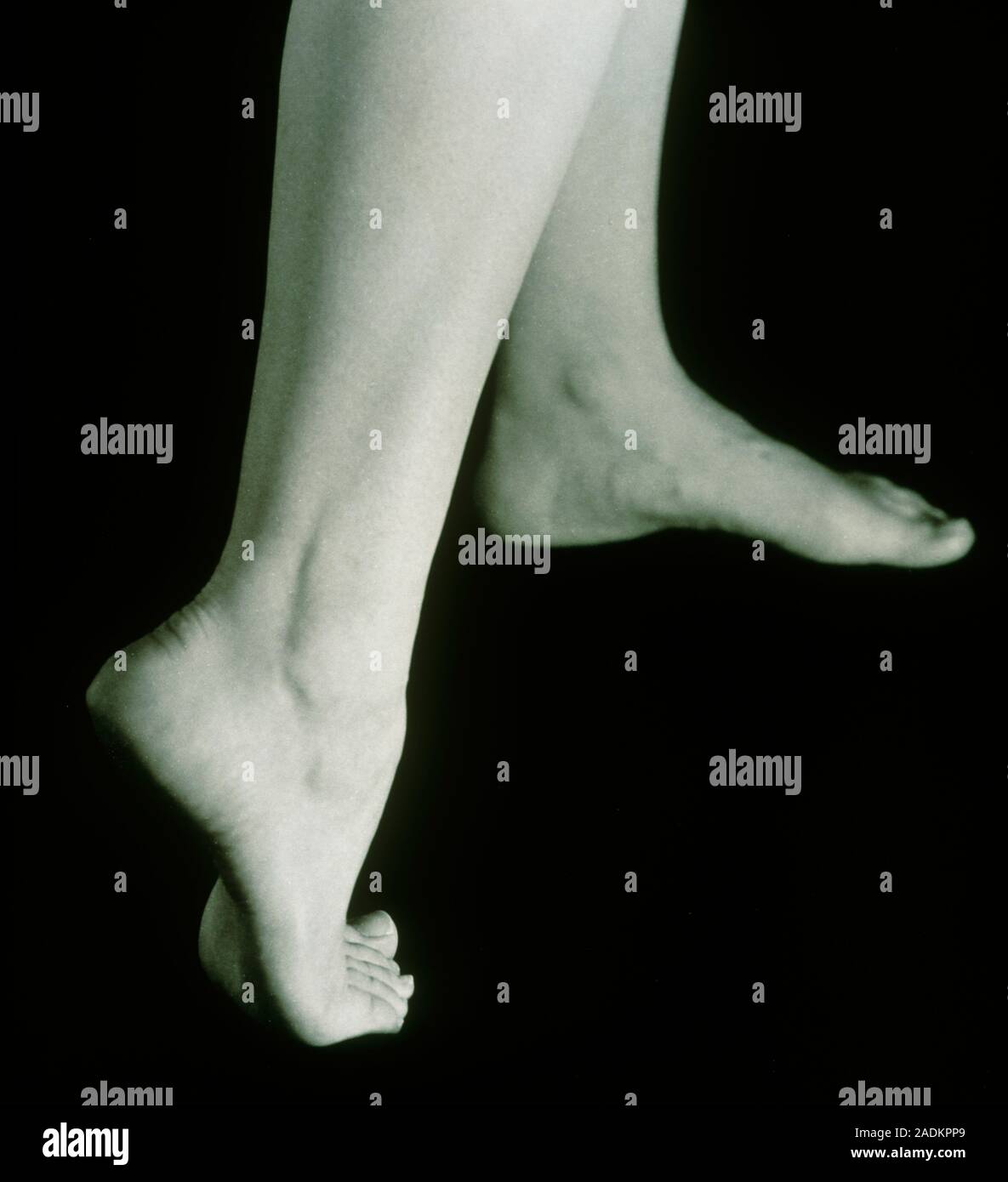 Feet. Healthy feet of a standing woman seen from the side. One of her ...