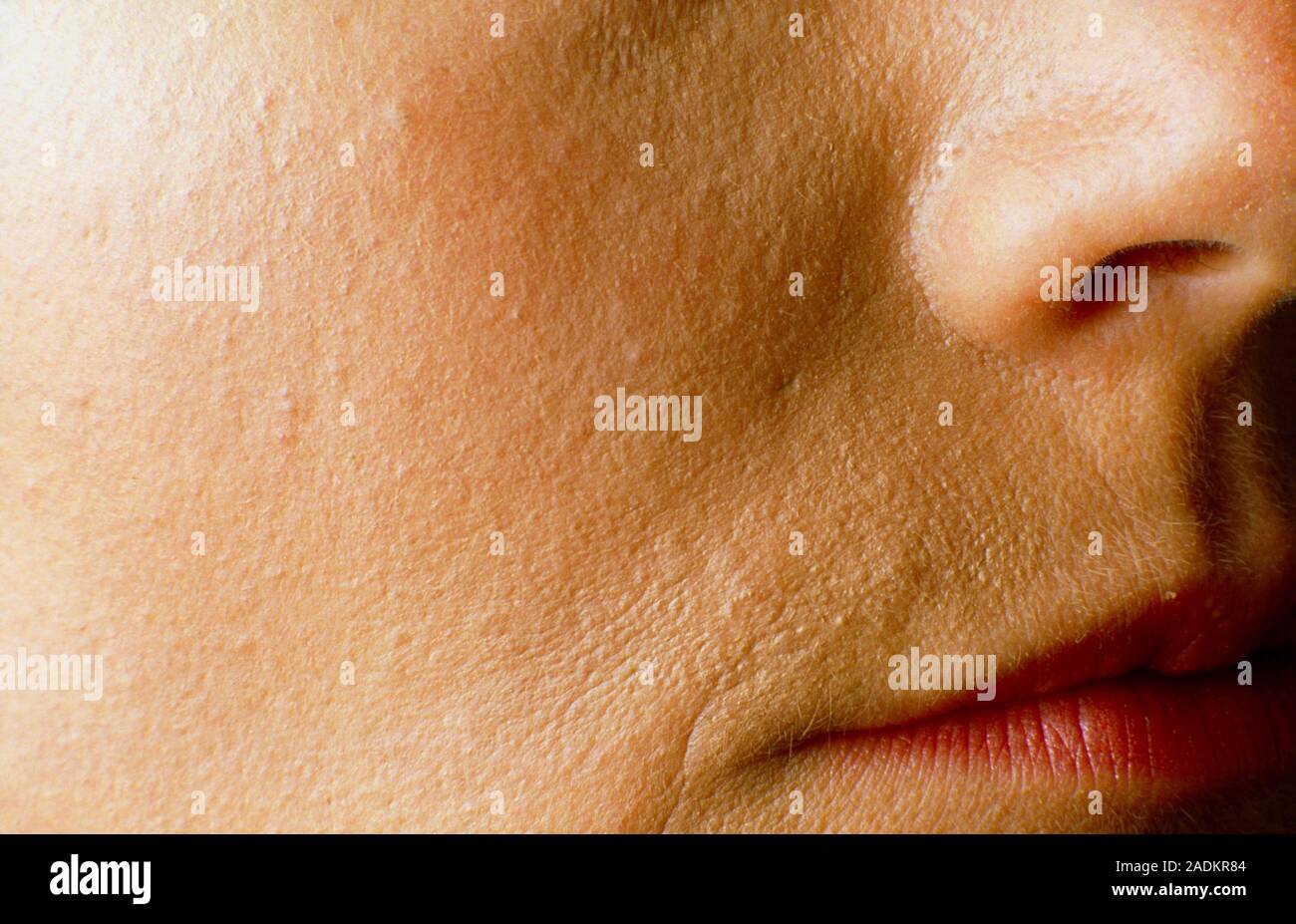 Woman's face heavily covered with make-up: a base of foundation cream ...