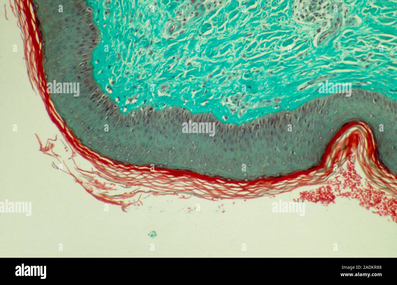 Light micrograph of a section of normal human skin showing the dermis ...