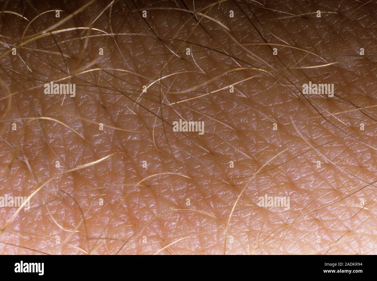 Macrophotograph of the skin on the back of the arm of a young male ...