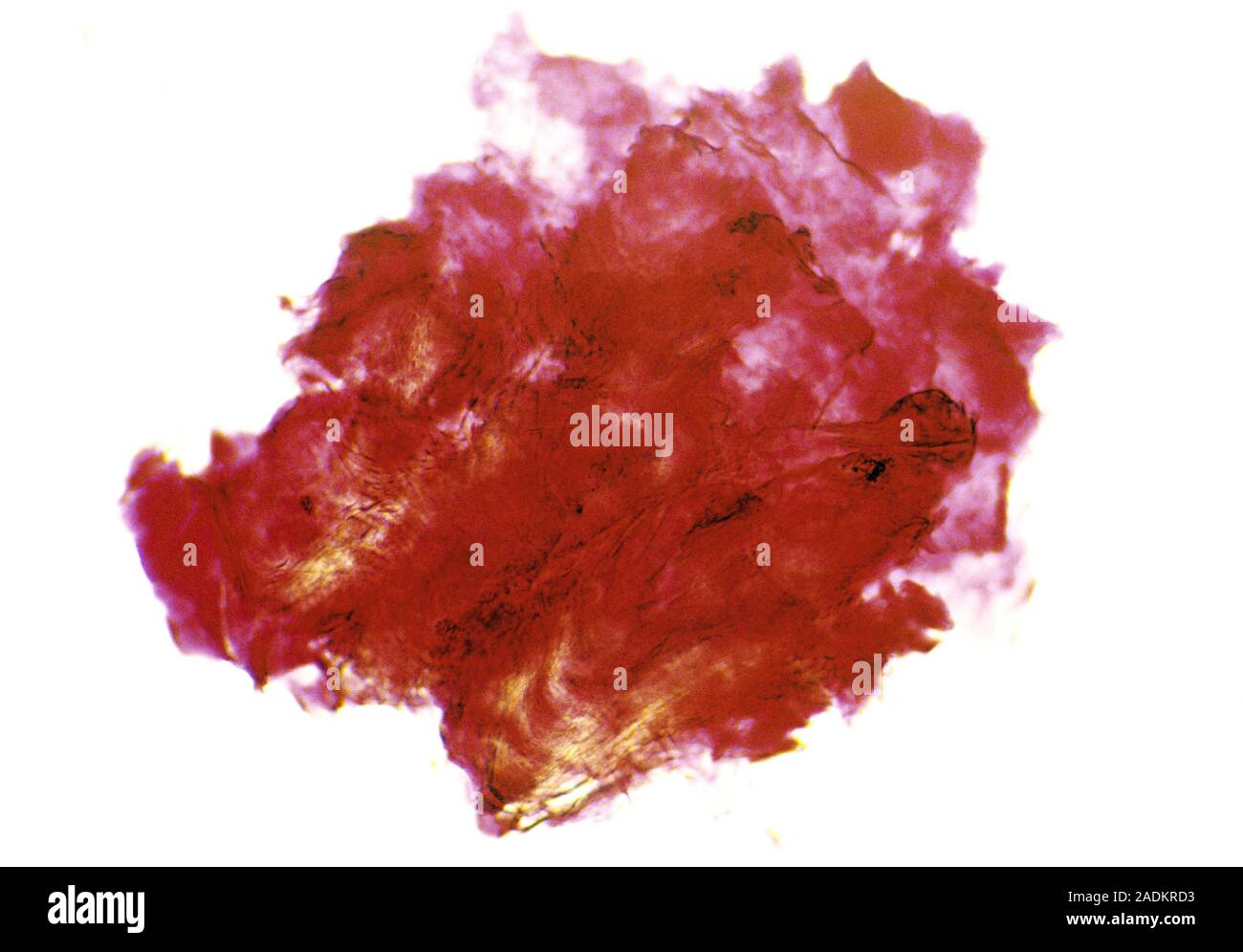 Dandruff flake. Light micrograph of a human dandruff flake. Dandruff is ...