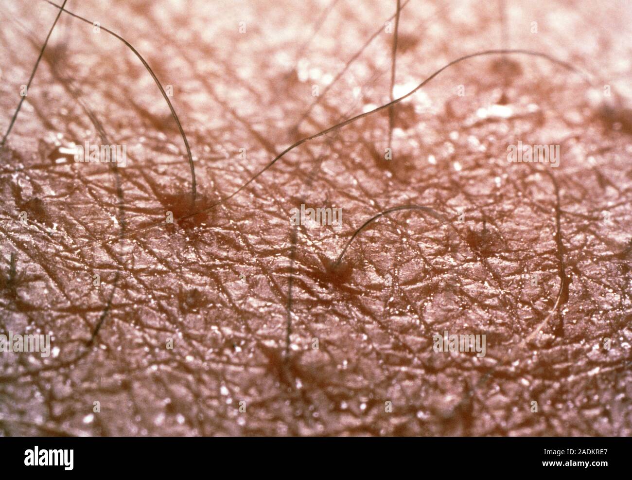Goose flesh. Macrophotograph of human skin showing goose flesh. This ...