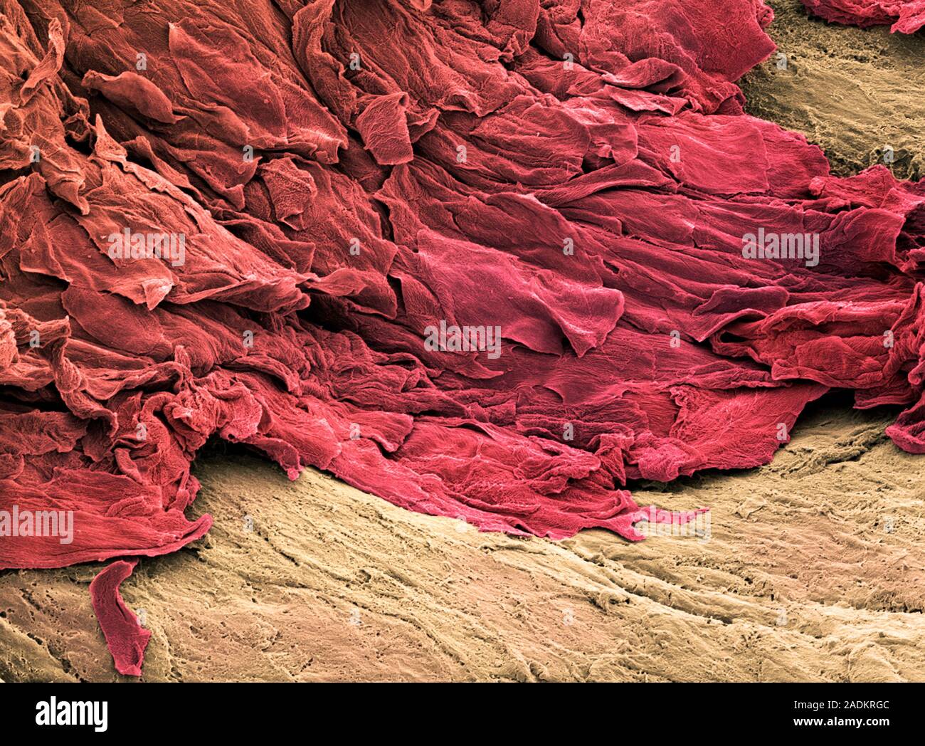 Wound scab. Coloured scanning electron micrograph (SEM) of ...