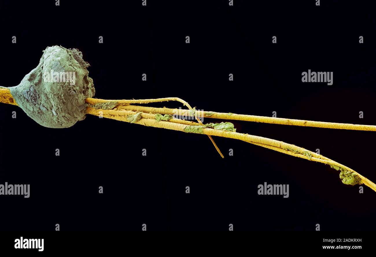 Blackhead. Coloured scanning electron micrograph (SEM) of a blackhead ...