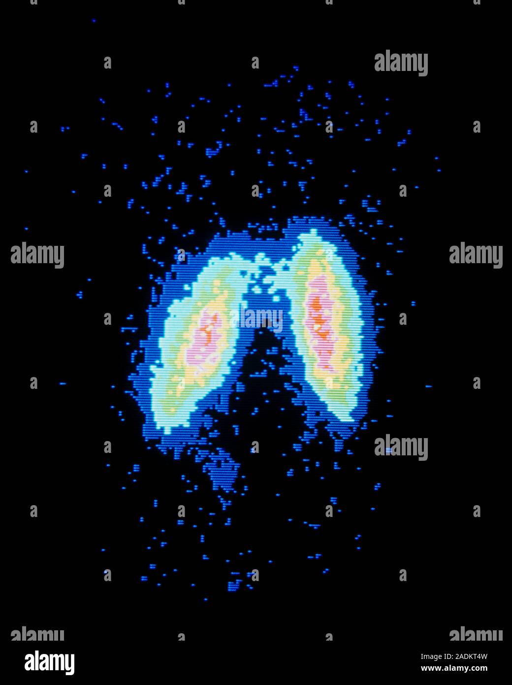 False-colour scintigram (gamma camera scan) of a normal human thryoid ...