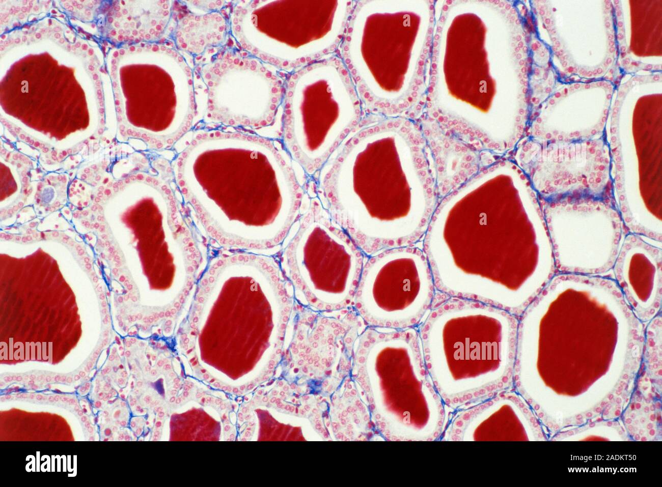 Light micrograph of normal human thyroid gland. The parenchyma of the ...