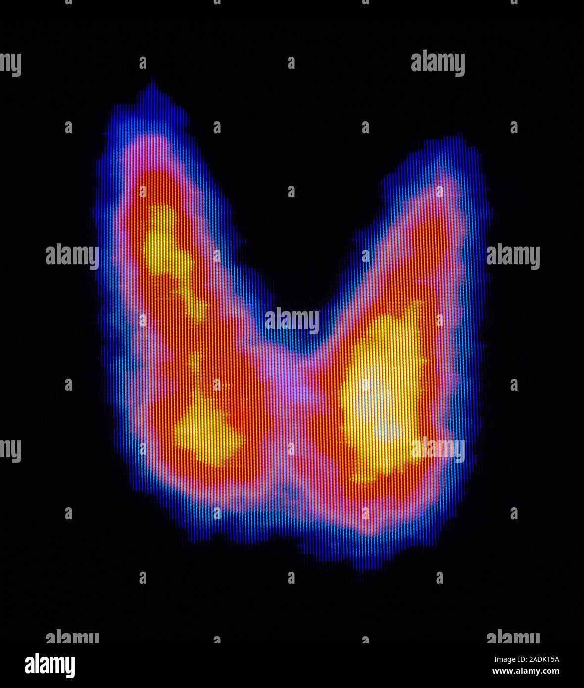 Thyroid gland. Coloured computer-enhanced gamma scan (scintigram) of a ...