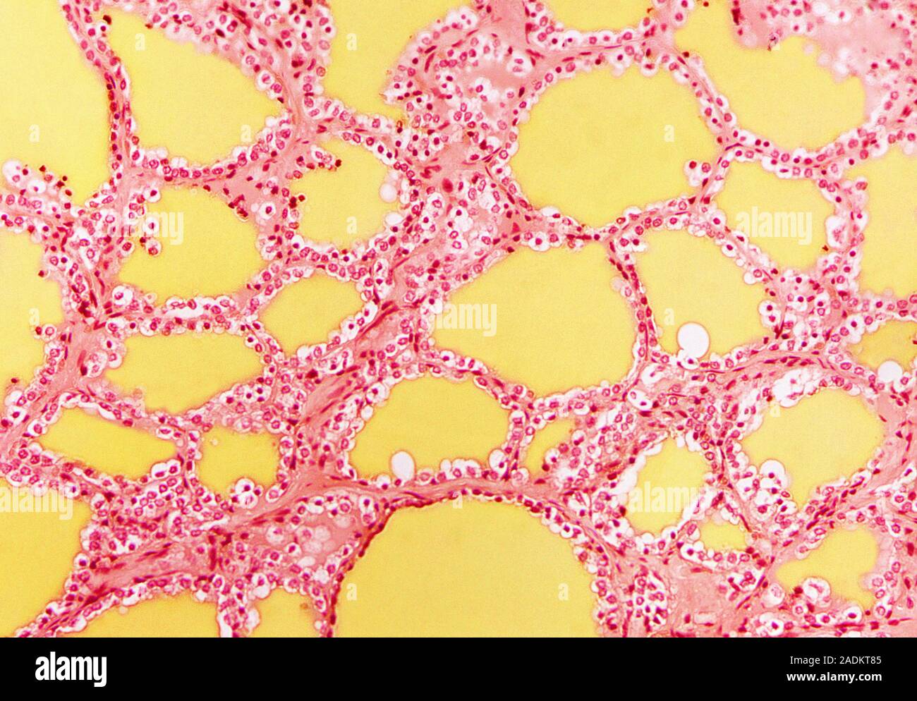 Thyroid gland. Coloured light micrograph of a thyroid gland showing the ...
