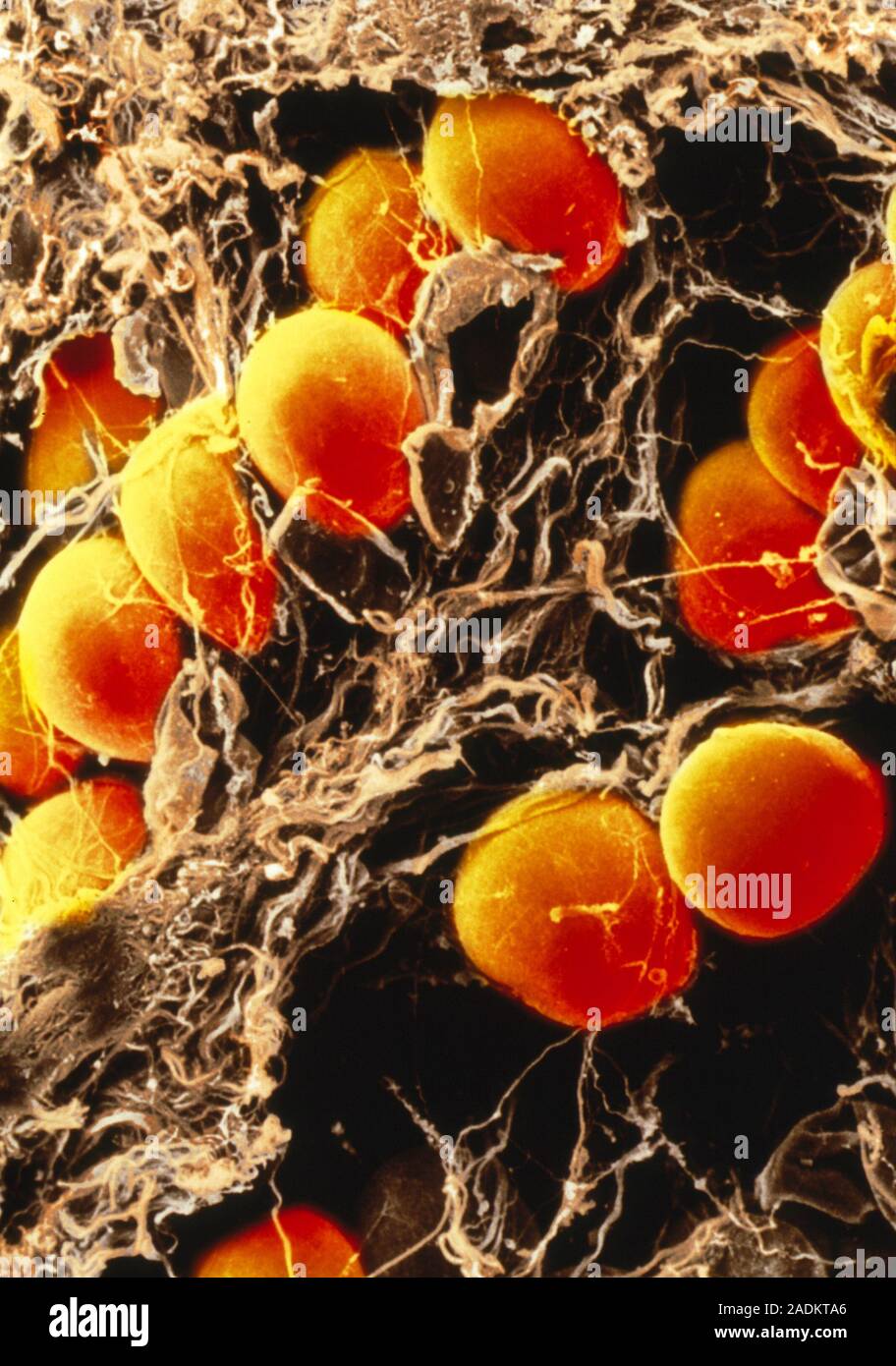 Fat cells. Coloured scanning electron micrograph of fat cells (orange ...