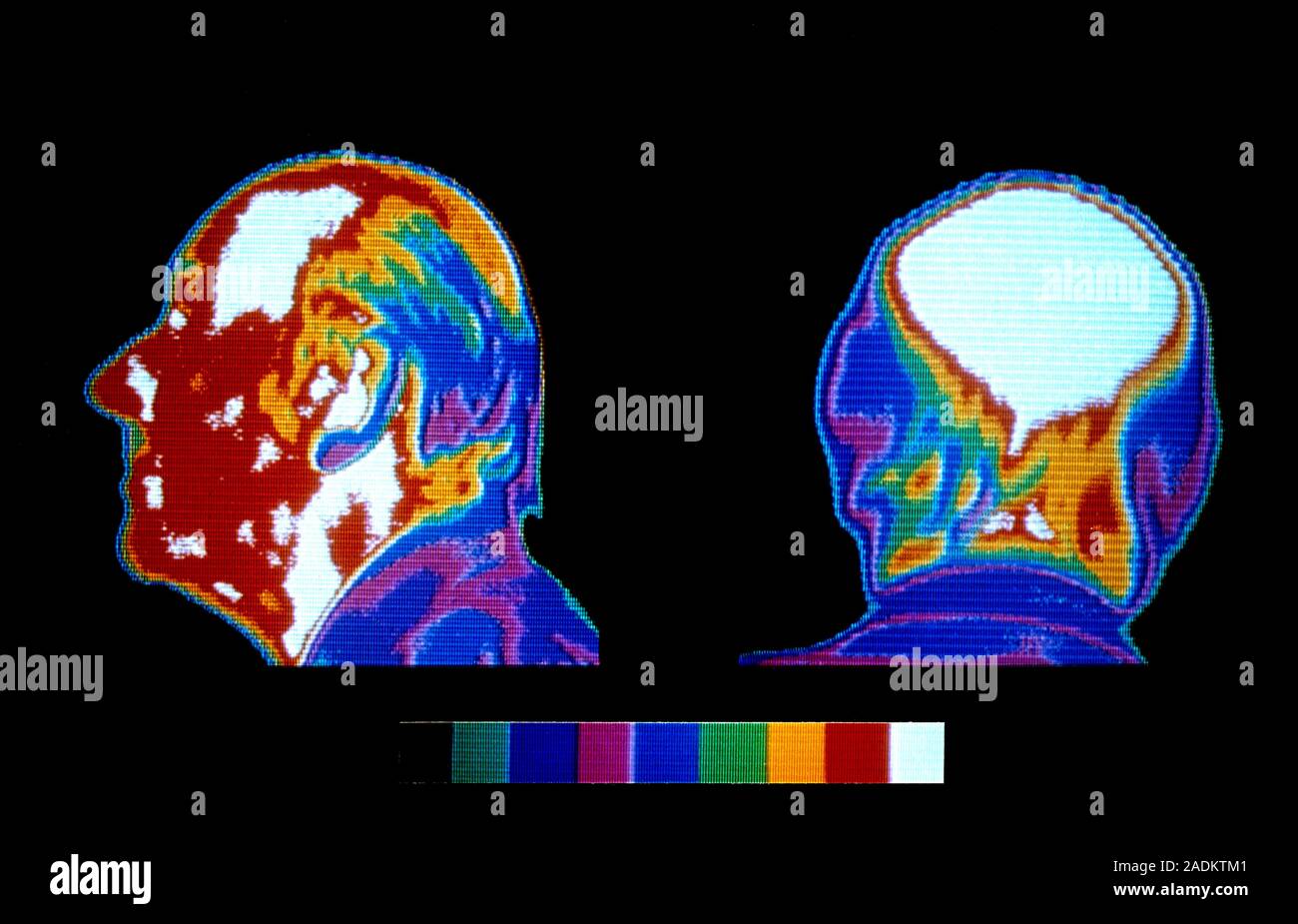 Pair of thermographs (side & rear views) of head of almost completely ...