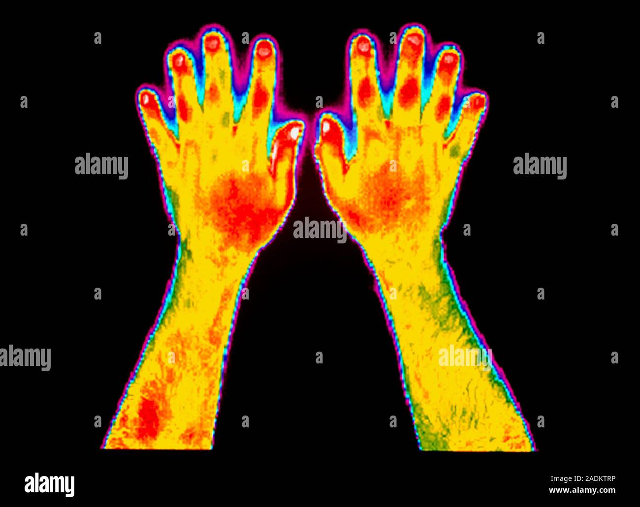 Forearms. Thermogram of forearms. The thermogram shows the temperature ...