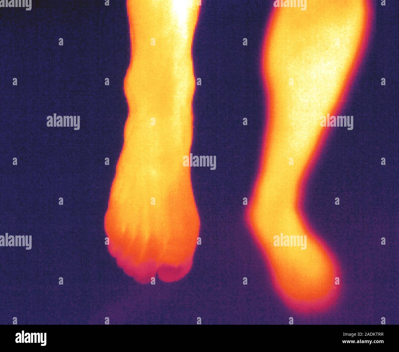 Feet. Thermogram of a man's feet showing the variation in skin surface ...