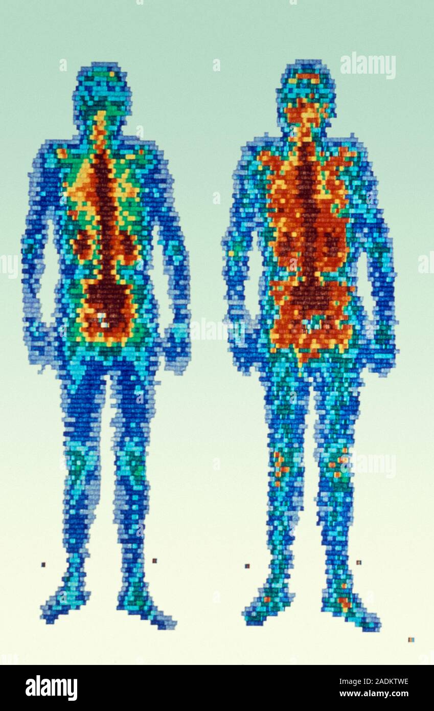 Full-body scans of a healthy man injected with a radioactive isotope ...