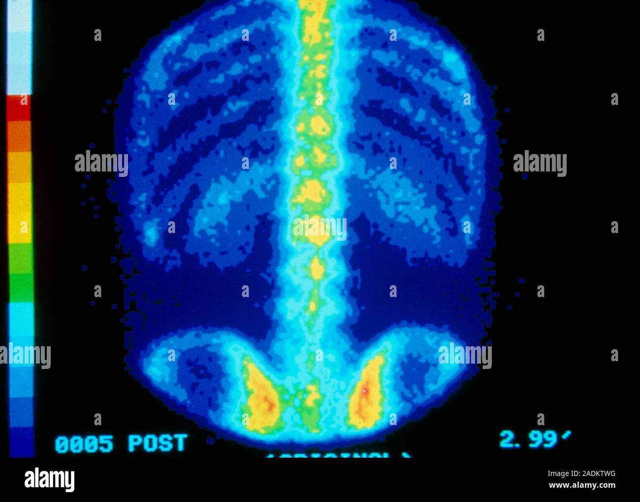 False colour bone scintigram (gamma camera scan) of a coronal (frontal ...
