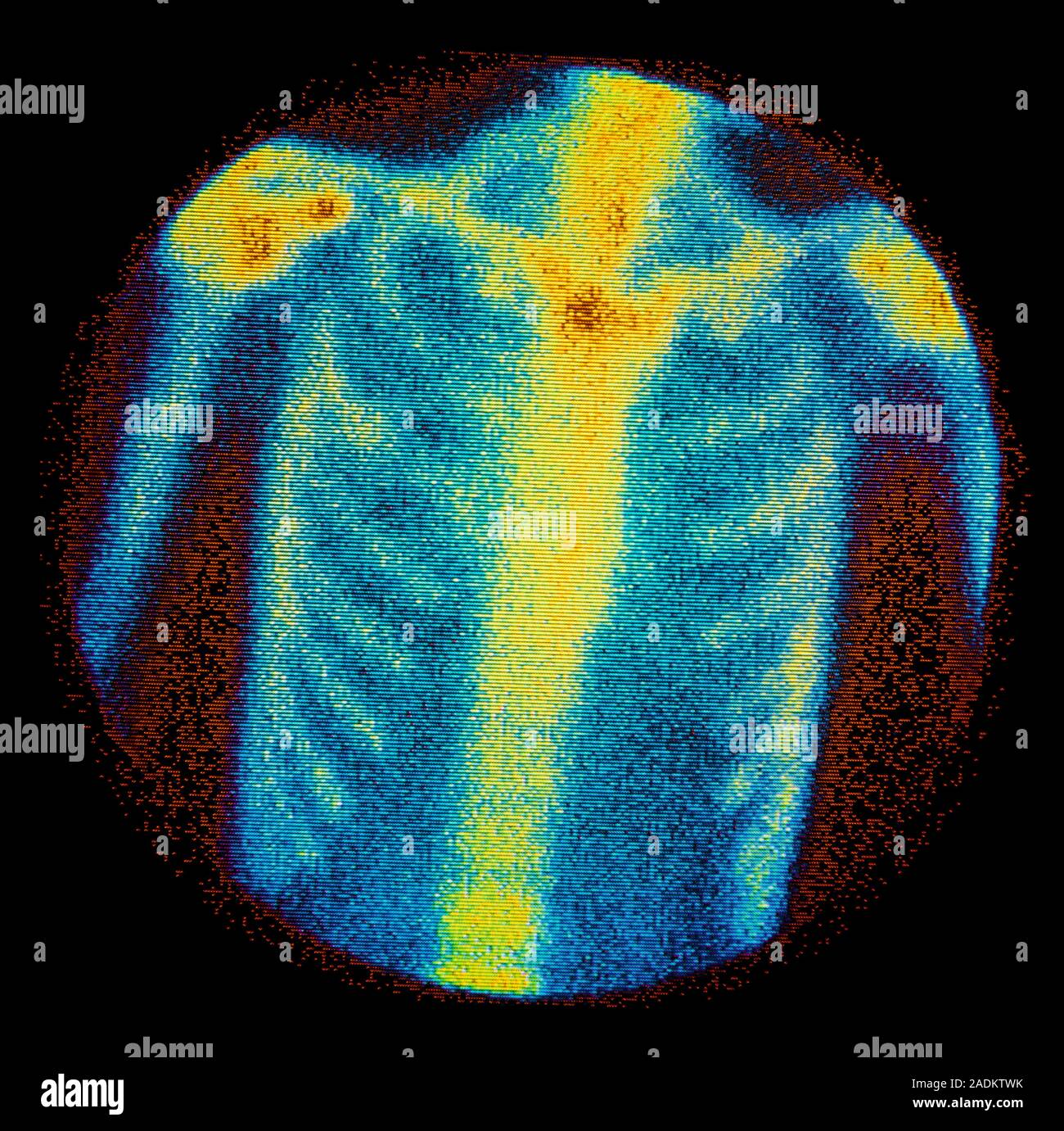 False-colour scintigram (bone scan) of a normal chest in anterior view. The scintigram is a map ...