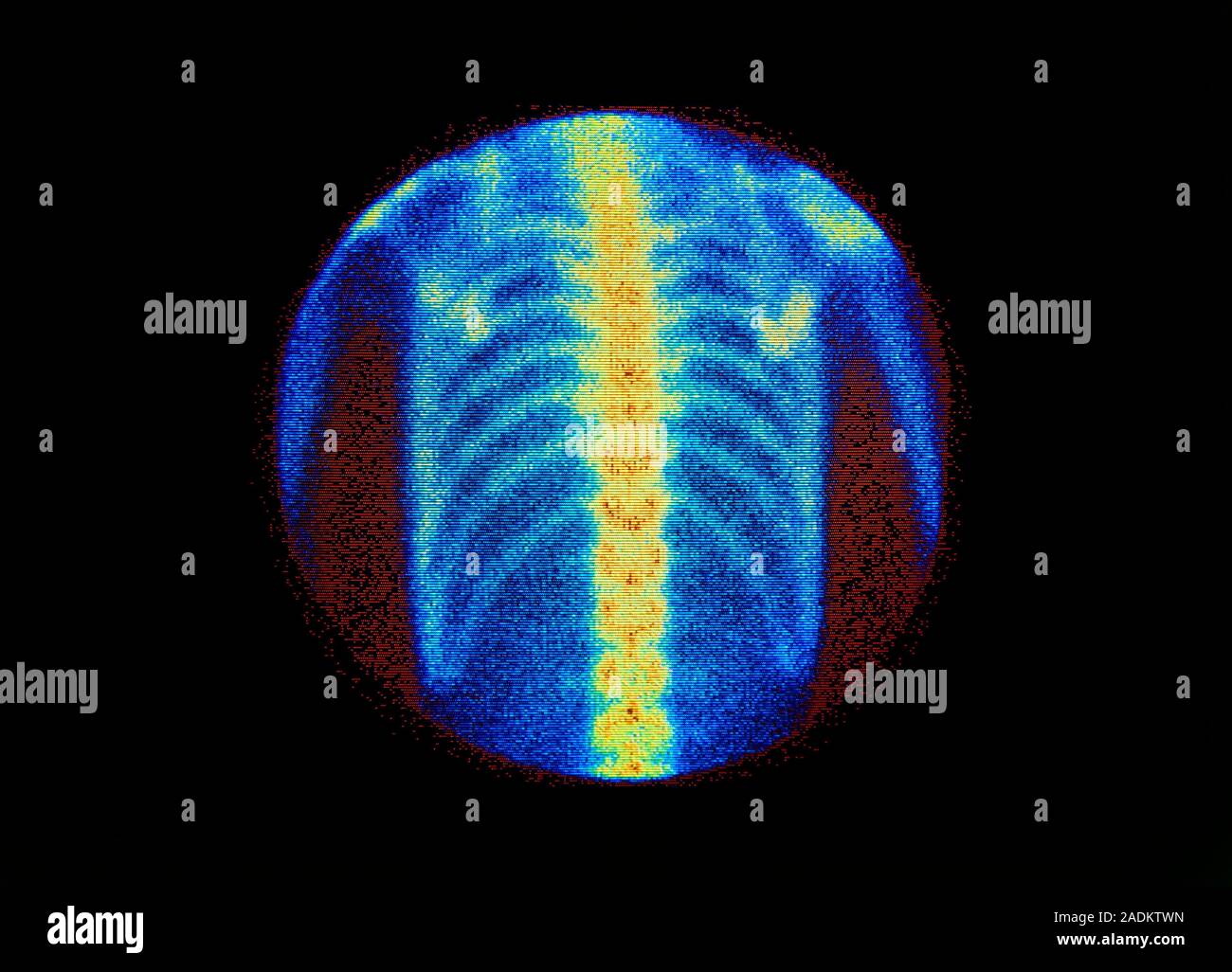 False-colour scintigram (bone scan) of a normal chest in posterior view ...