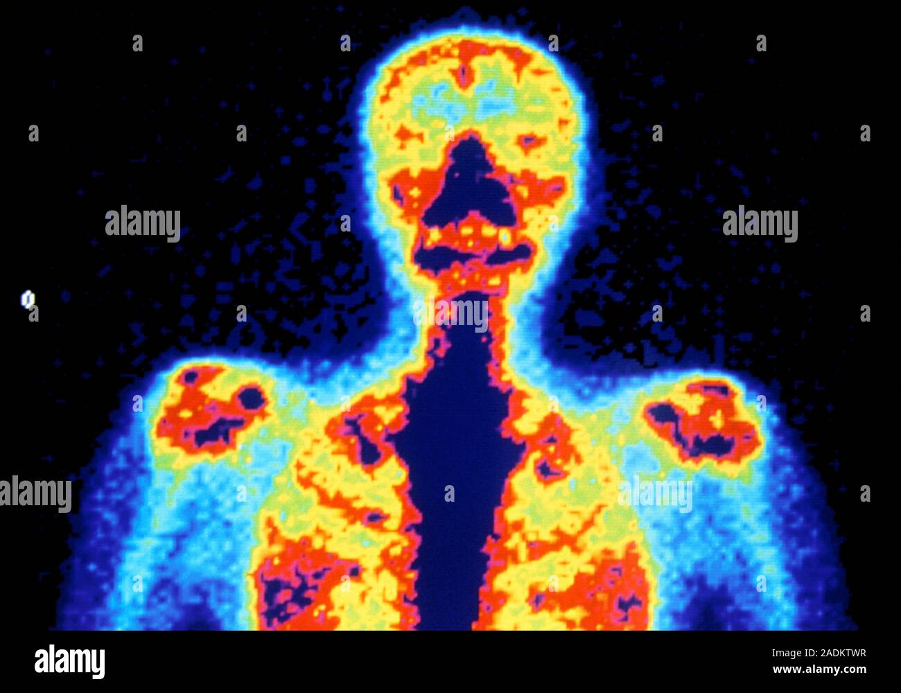 Bone scan of upper body. Coloured radionuclide bone scan (gamma scan ...