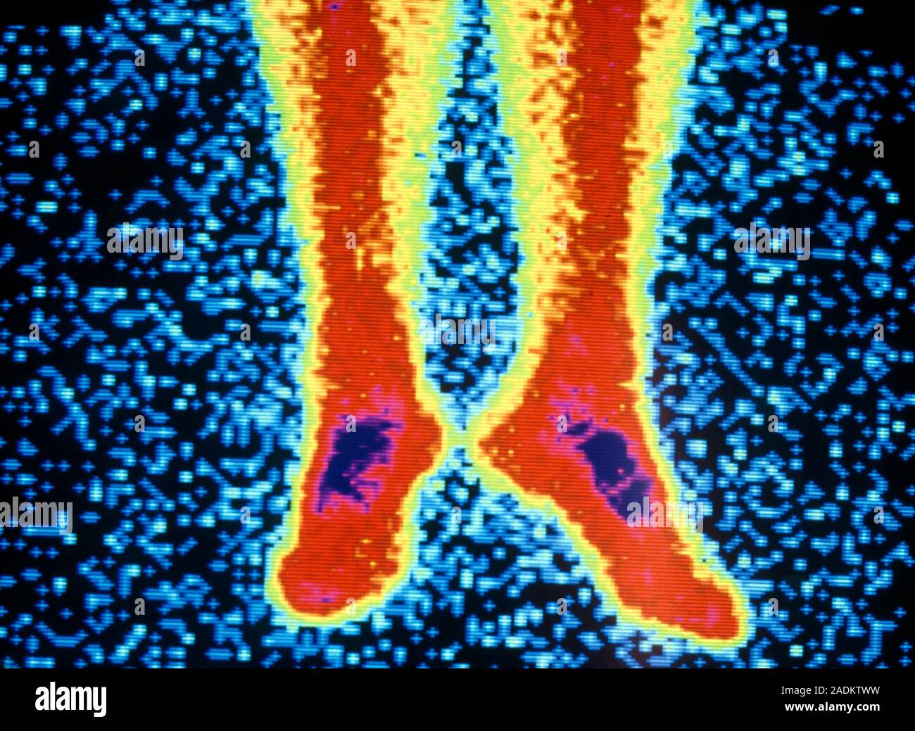 Bone scan of legs and feet. Coloured radionuclide bone scan (gamma scan ...