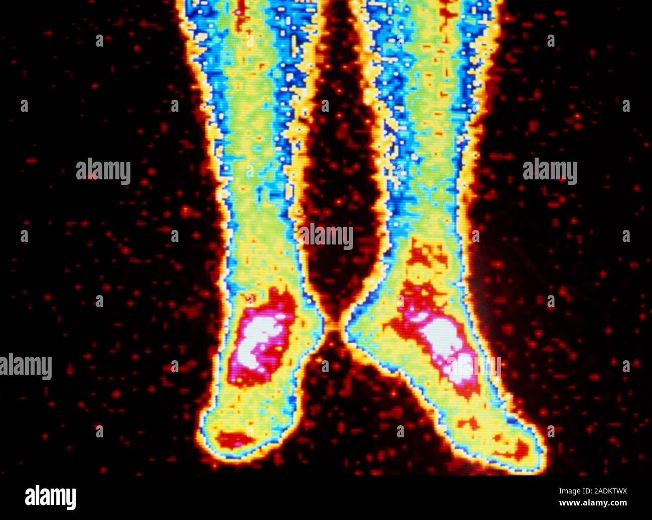 Bone scan of legs and feet. Coloured radionuclide bone scan (gamma scan ...