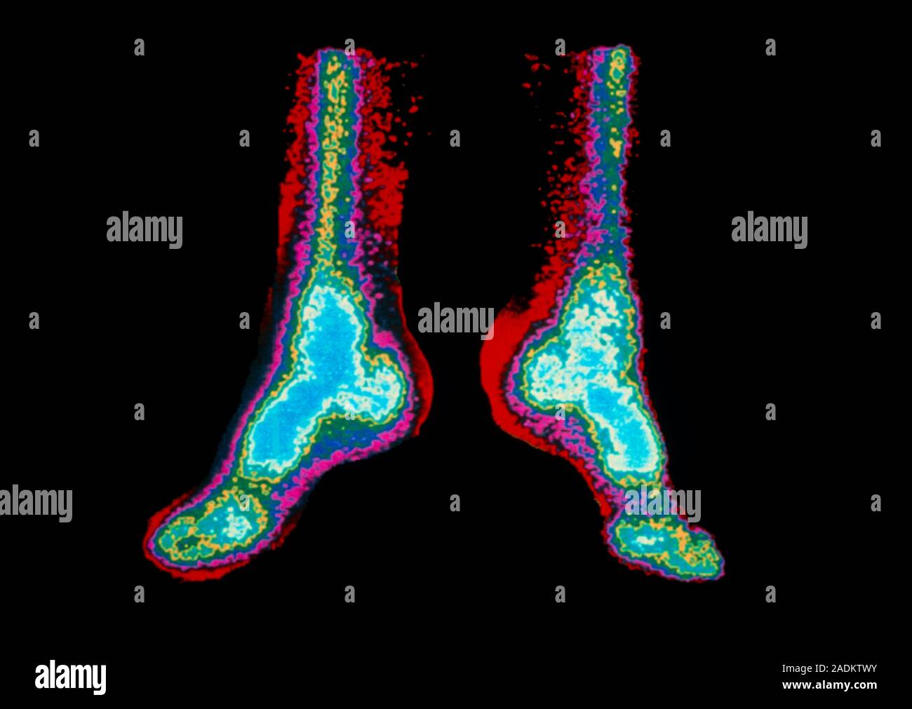 Bone scan of legs and feet. Coloured radionuclide bone scan (gamma scan ...