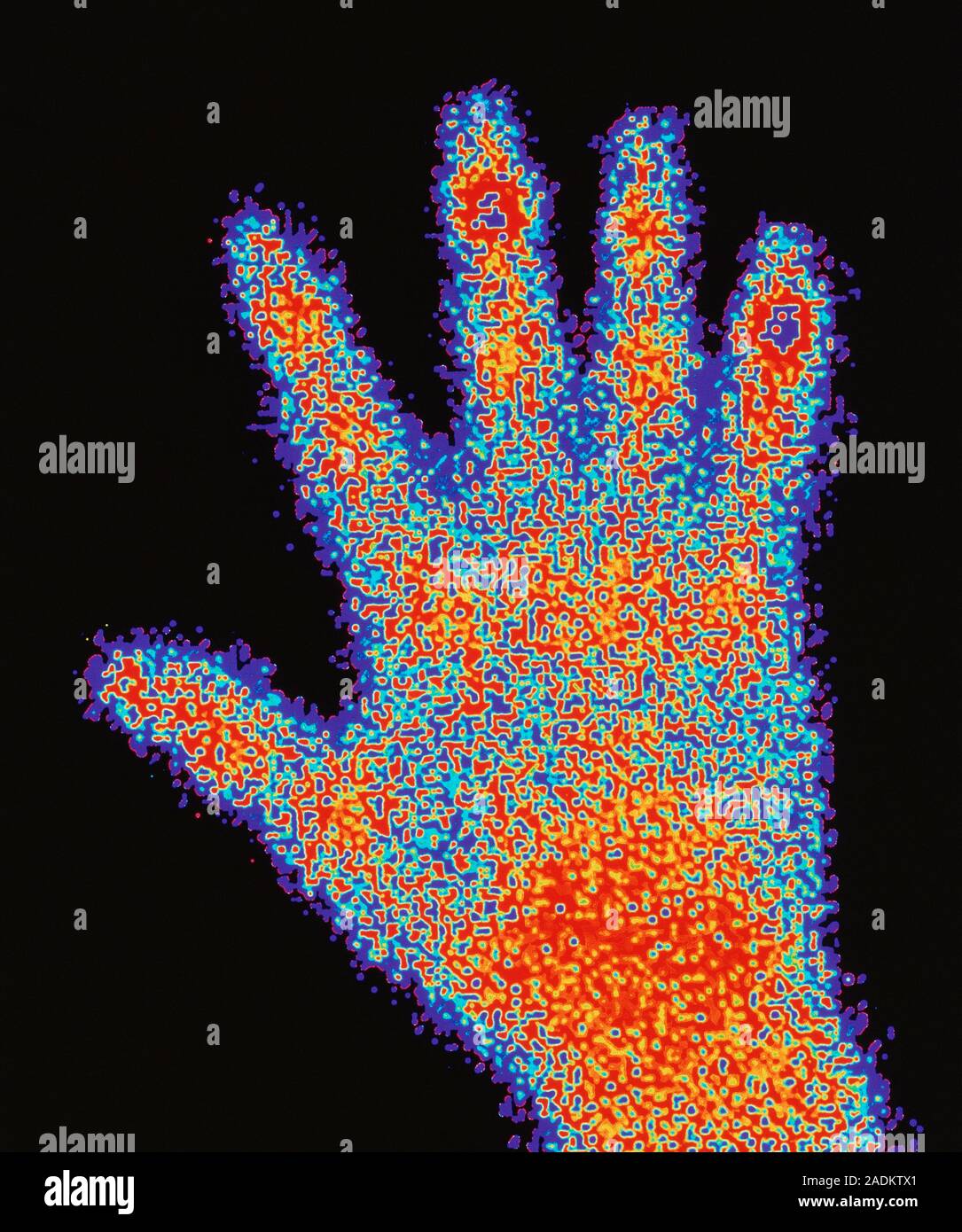 Bone scan of hand. Coloured radionuclide bone scan (gamma scan or ...