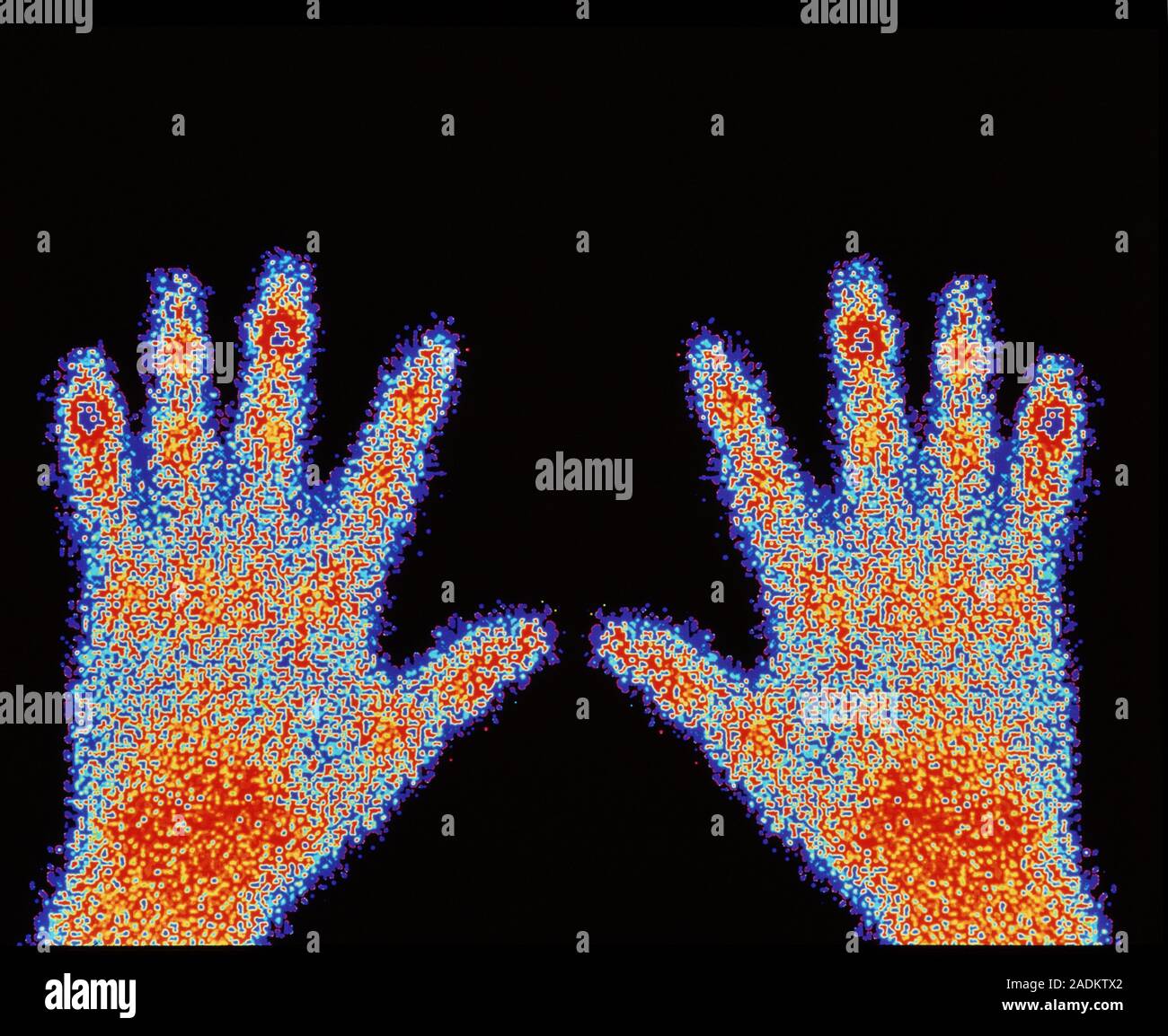 Bone scan of a pair of hands.Coloured radionuclide bone scan (gamma ...